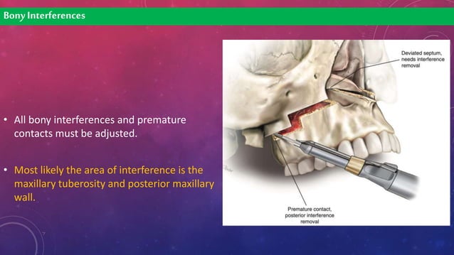 Maxillary osteotomy | PPTX