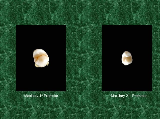 morphology of maxillary premolar teeth | PPT | Dental Health | Diseases ...