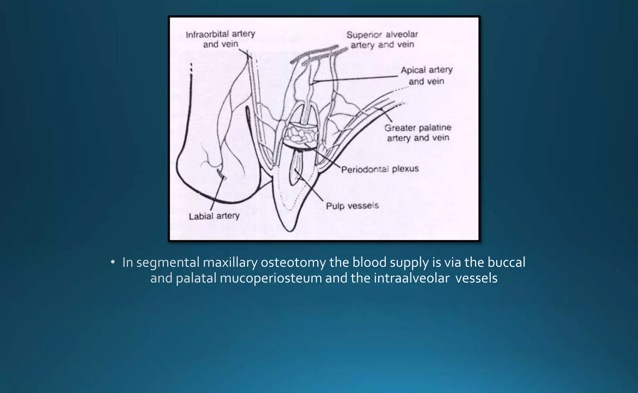 Maxillary procedures and soft tissue changes | PPTX