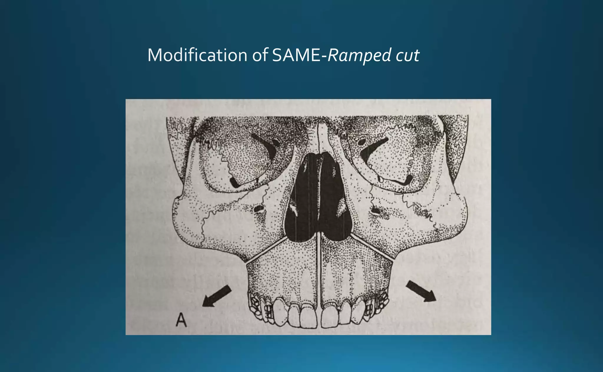 Maxillary procedures and soft tissue changes | PPTX