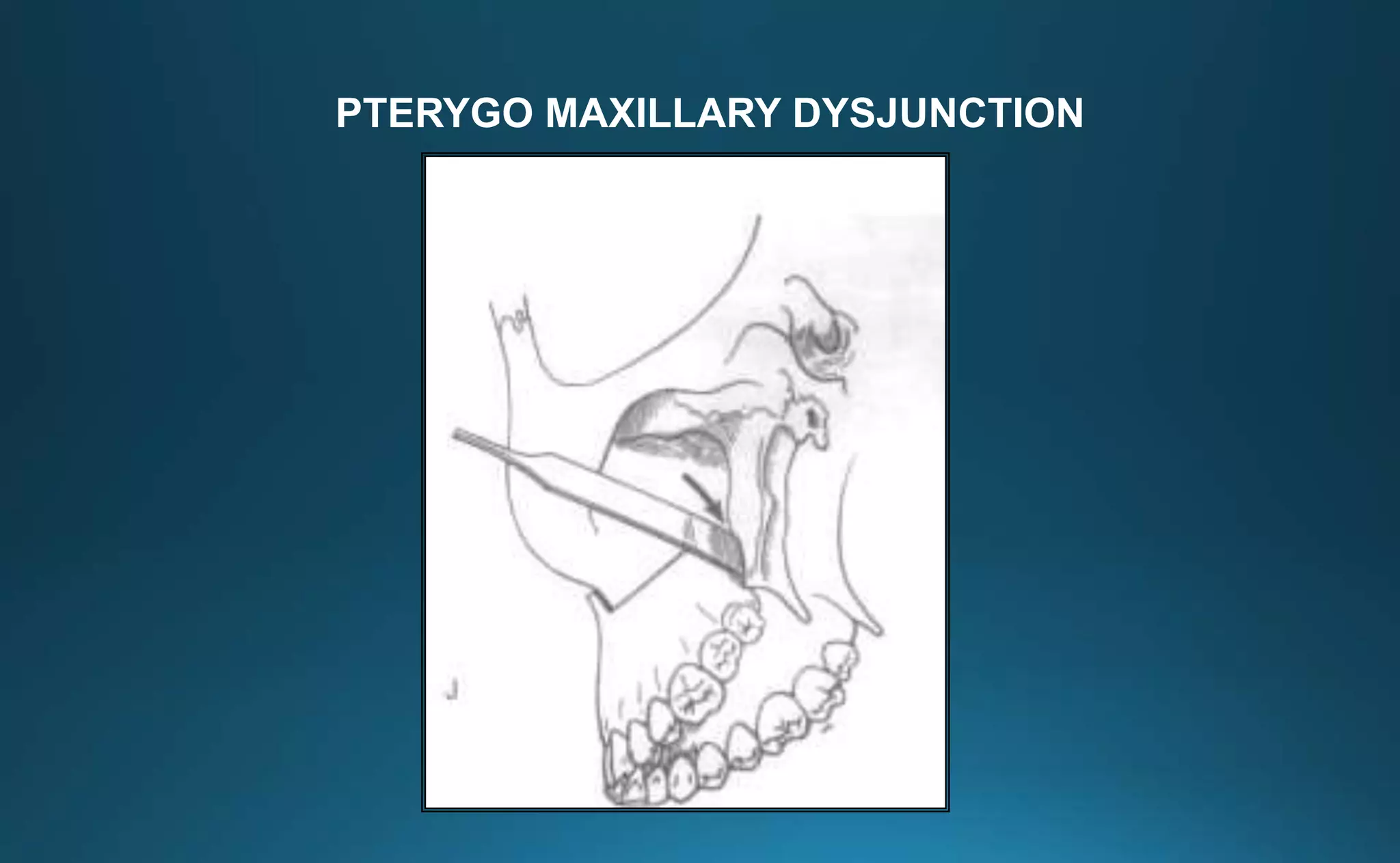 Maxillary procedures and soft tissue changes | PPTX