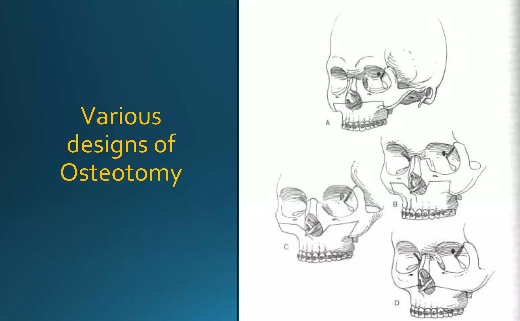 Maxillary procedures and soft tissue changes | PPTX