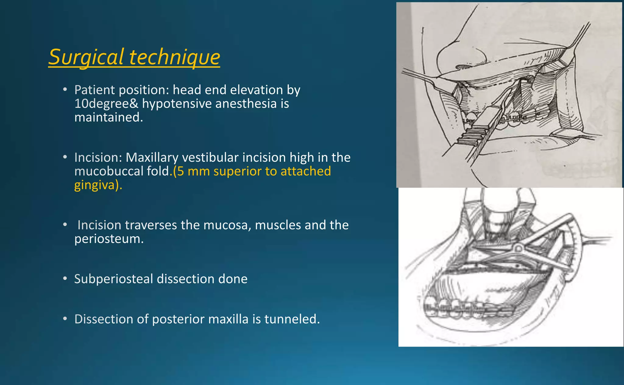 Maxillary procedures and soft tissue changes | PPTX