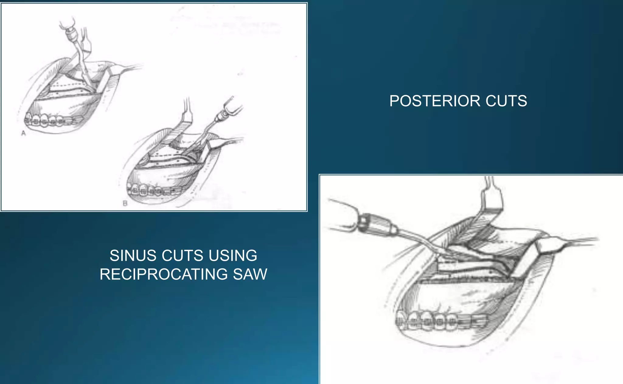 Maxillary procedures and soft tissue changes | PPTX