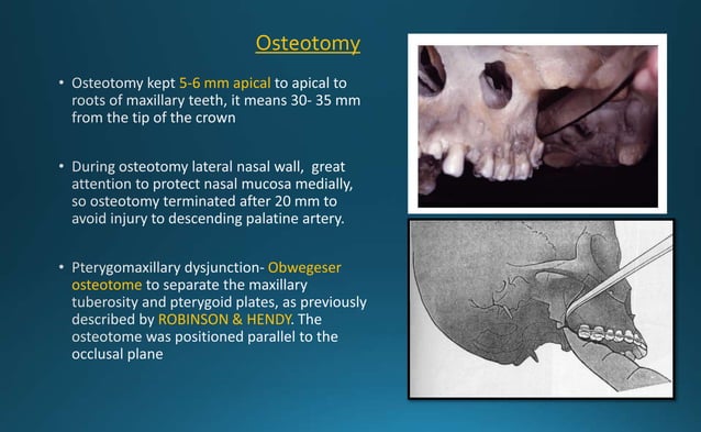 Maxillary procedures and soft tissue changes | PPTX