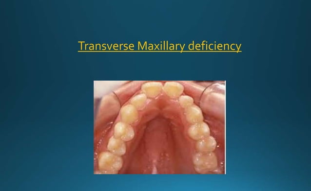 Maxillary procedures and soft tissue changes | PPTX