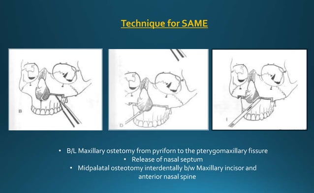 Maxillary procedures and soft tissue changes | PPTX