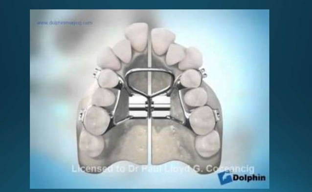 Maxillary procedures and soft tissue changes | PPTX