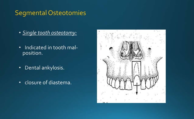 Maxillary procedures and soft tissue changes | PPTX
