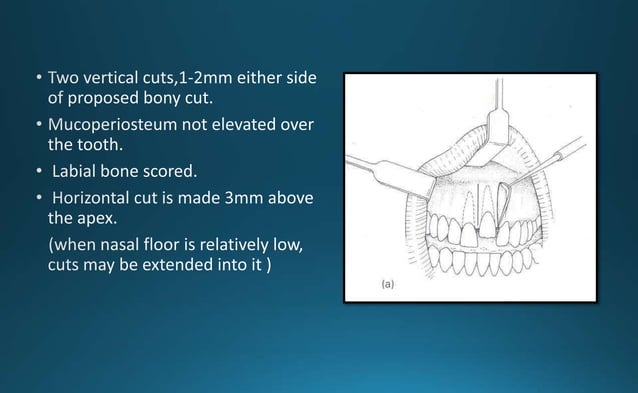 Maxillary procedures and soft tissue changes | PPTX