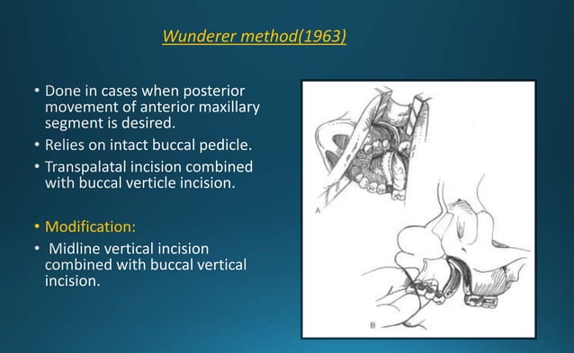 Maxillary procedures and soft tissue changes | PPTX