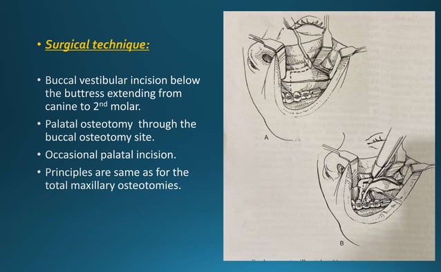 Maxillary procedures and soft tissue changes | PPTX