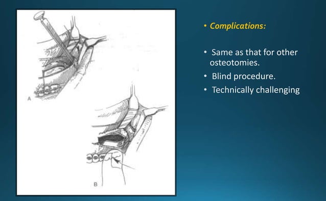 Maxillary procedures and soft tissue changes | PPTX