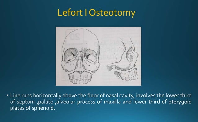 Maxillary procedures and soft tissue changes | PPTX