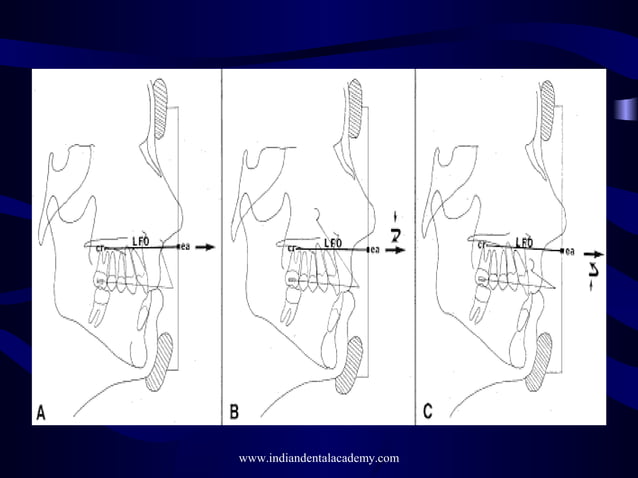 Maxillary protraction /certified fixed orthodontic courses by Indian ...