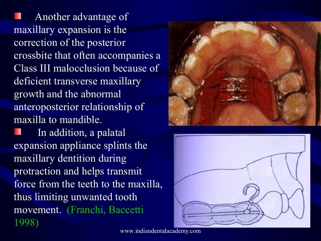 Maxillary protraction /certified fixed orthodontic courses by Indian