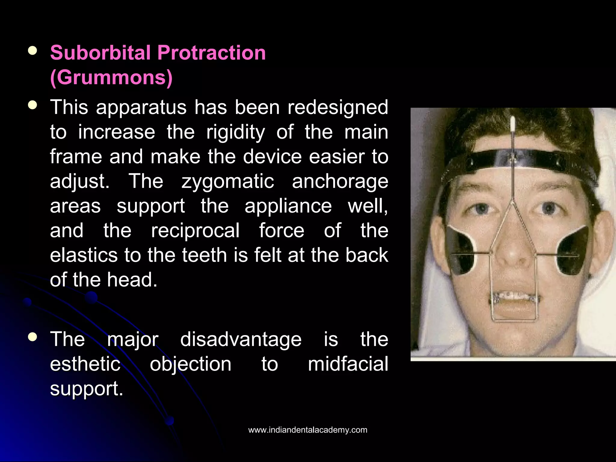 Maxillary protraction in orthodontics | PPT