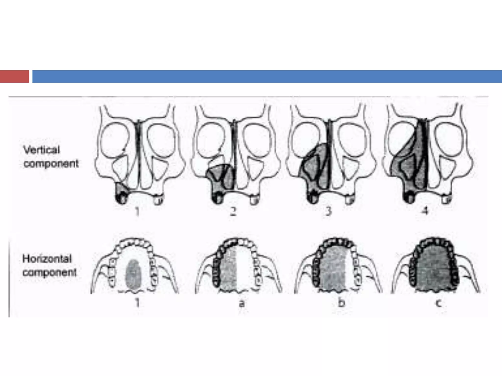 Maxillary reconstruction ih | PPTX
