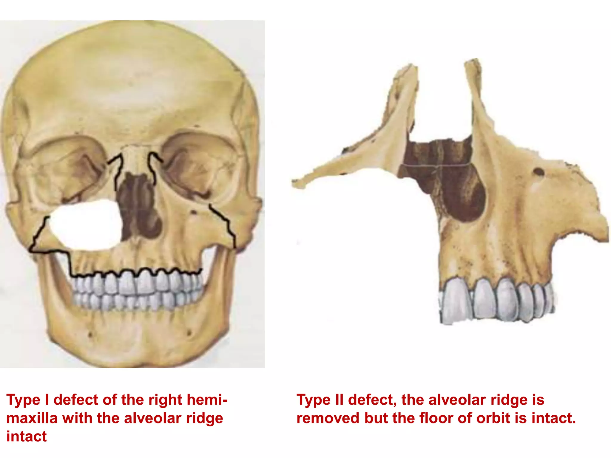 Maxillary reconstruction ih | PPTX