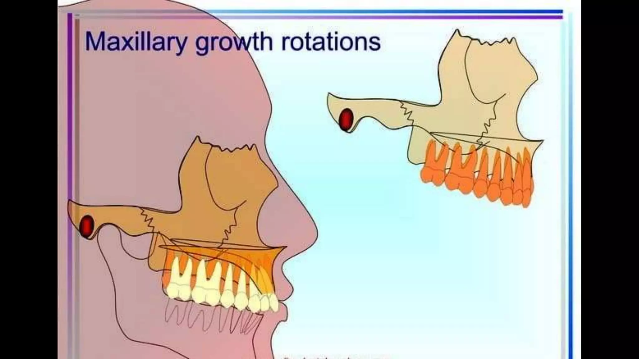 MAXILLARY ROTATION.pptx