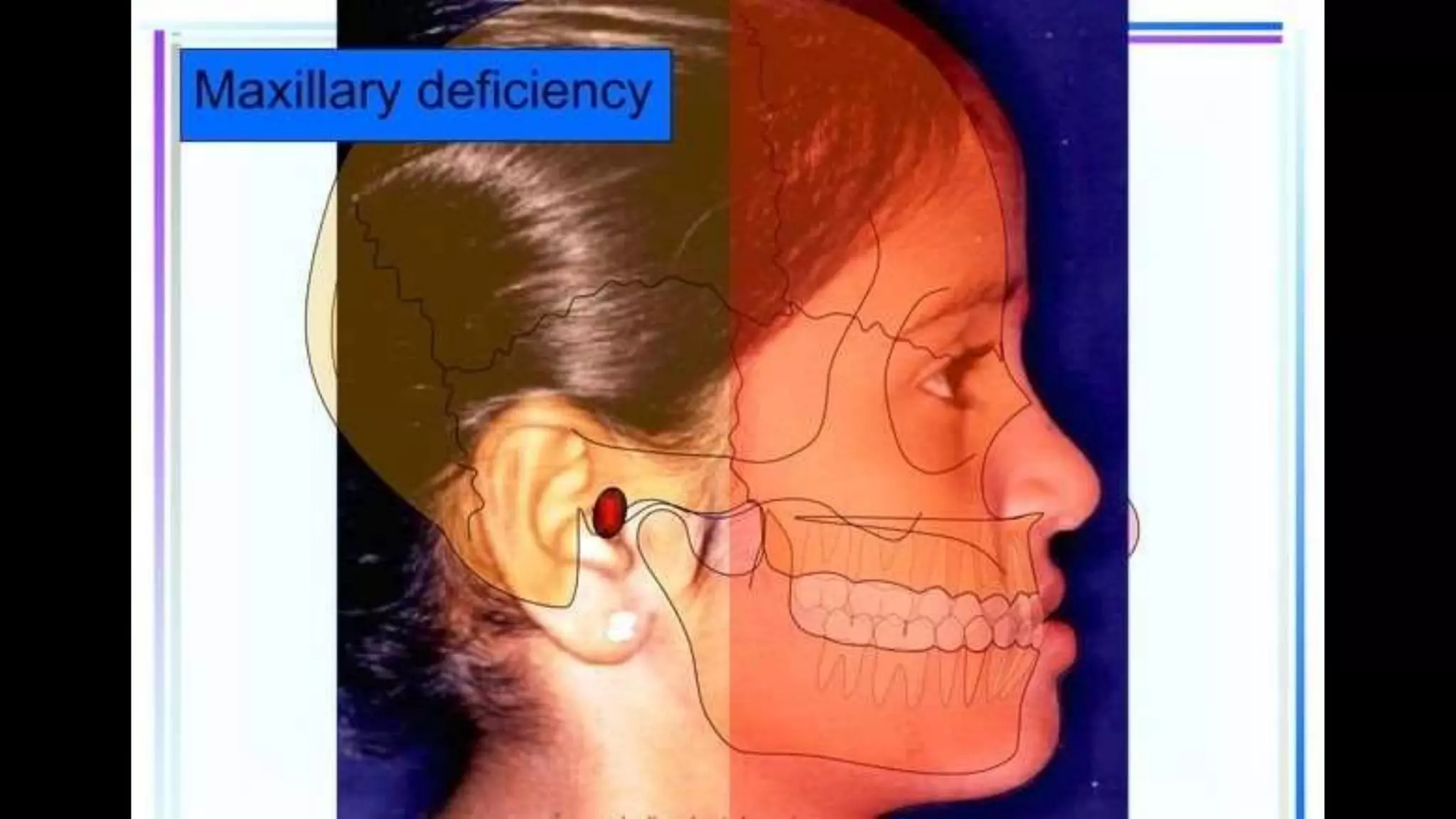MAXILLARY ROTATION.pptx