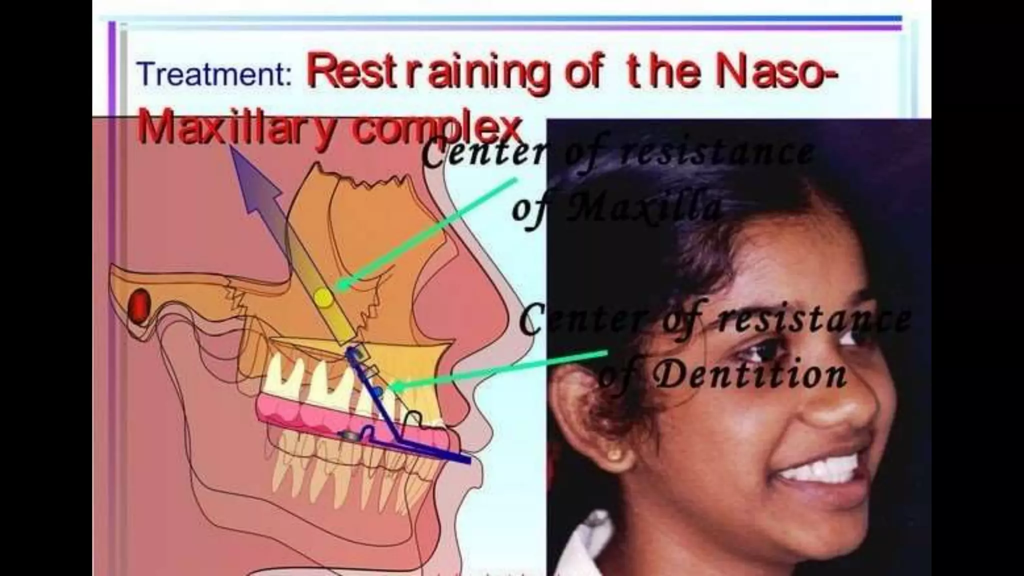 MAXILLARY ROTATION.pptx