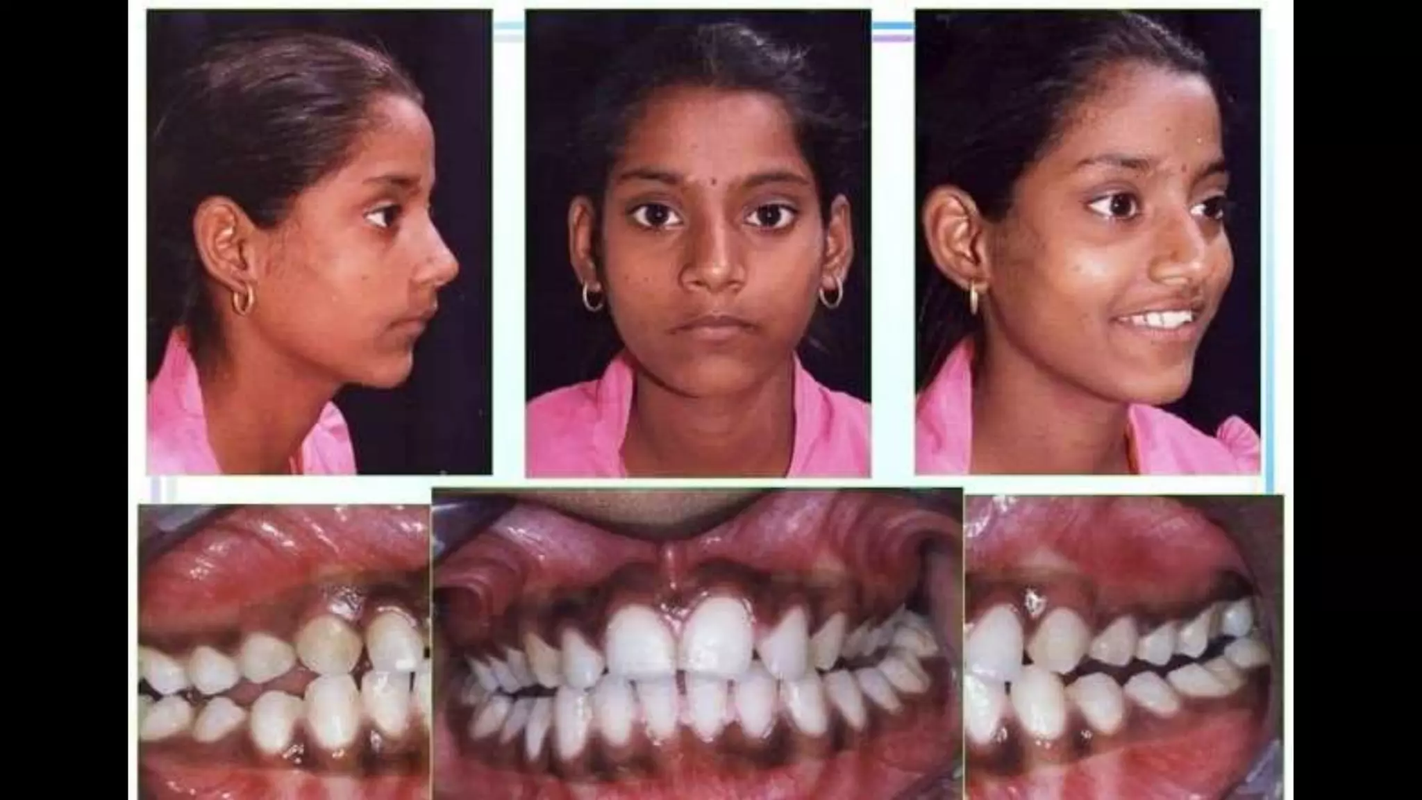 MAXILLARY ROTATION.pptx