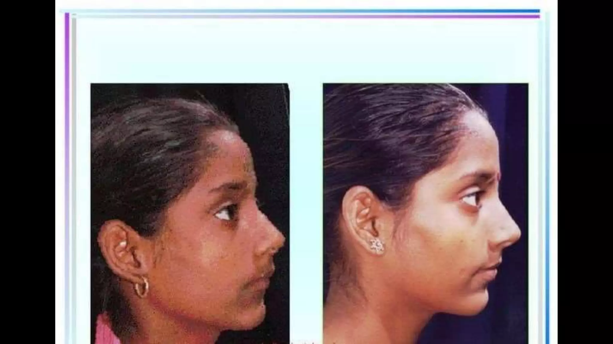 MAXILLARY ROTATION.pptx