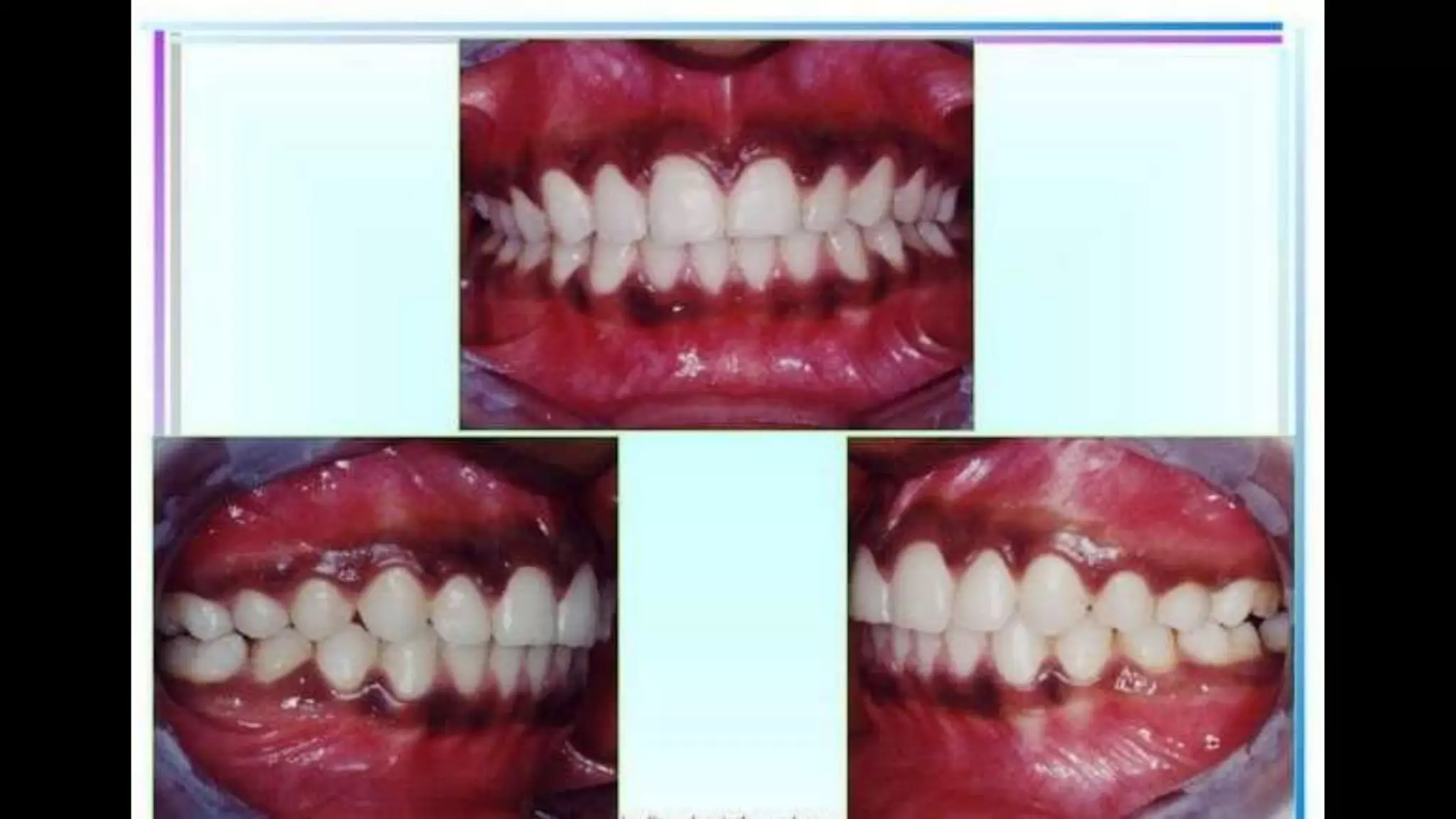 MAXILLARY ROTATION.pptx