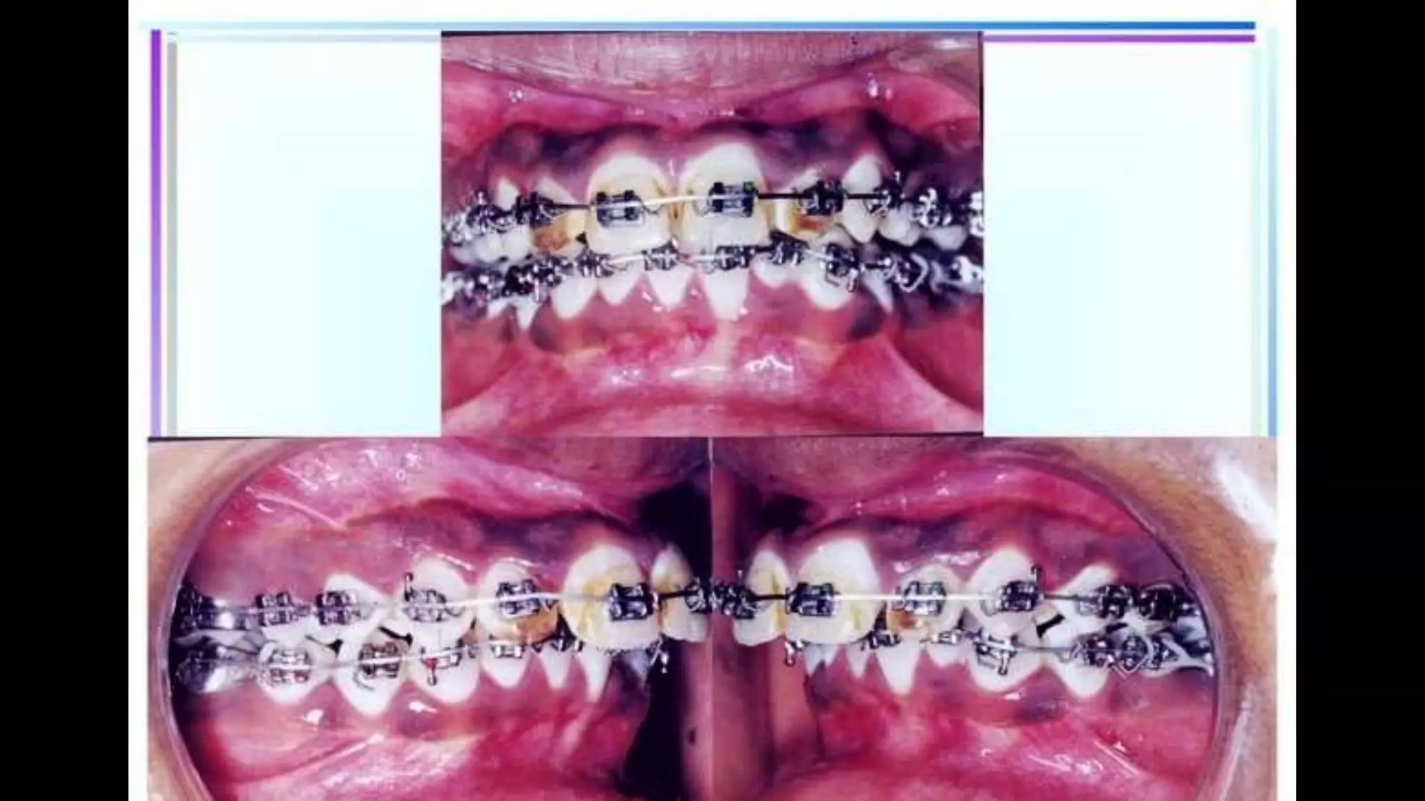 MAXILLARY ROTATION.pptx