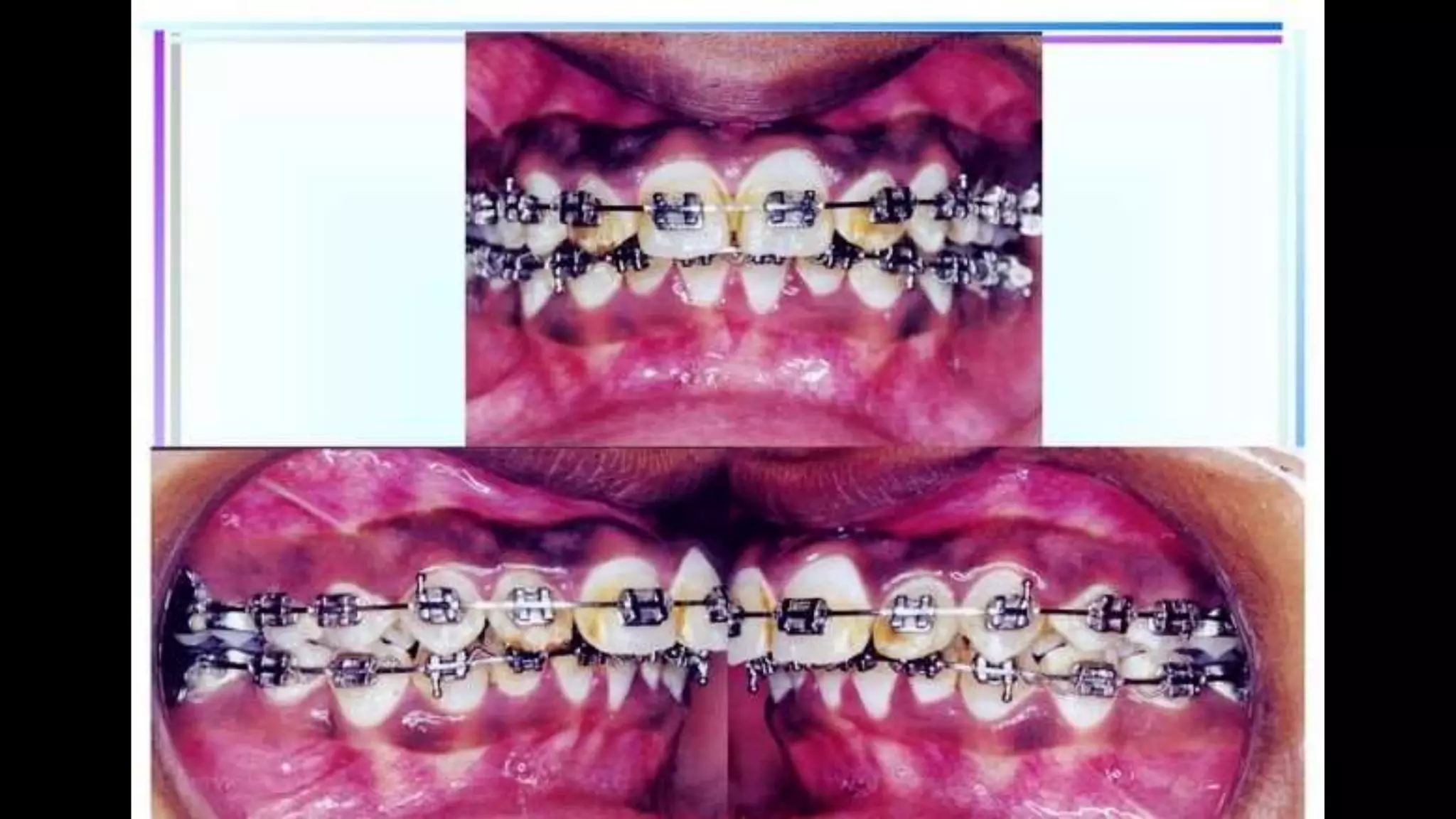 MAXILLARY ROTATION.pptx | Free Download