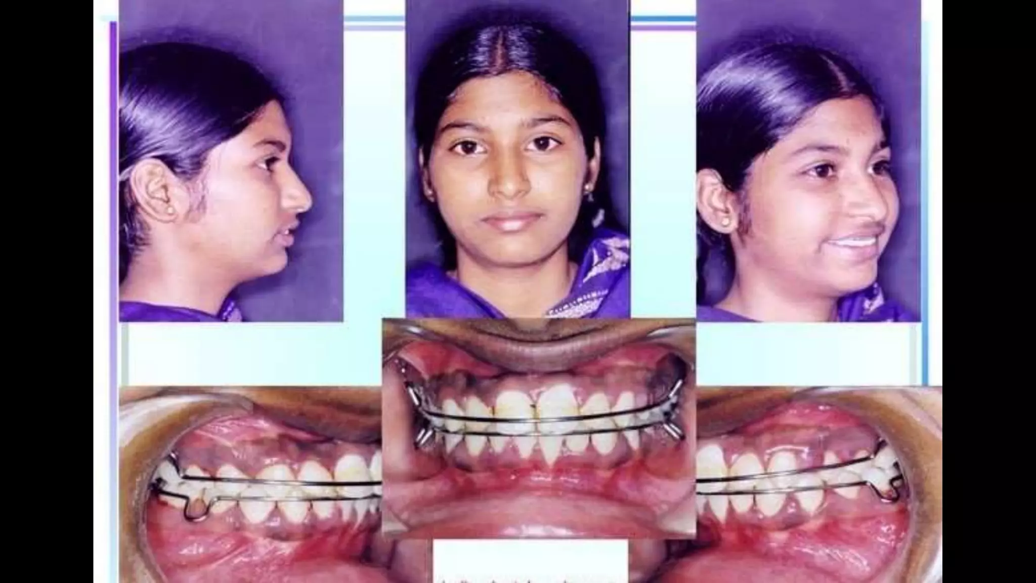 MAXILLARY ROTATION.pptx