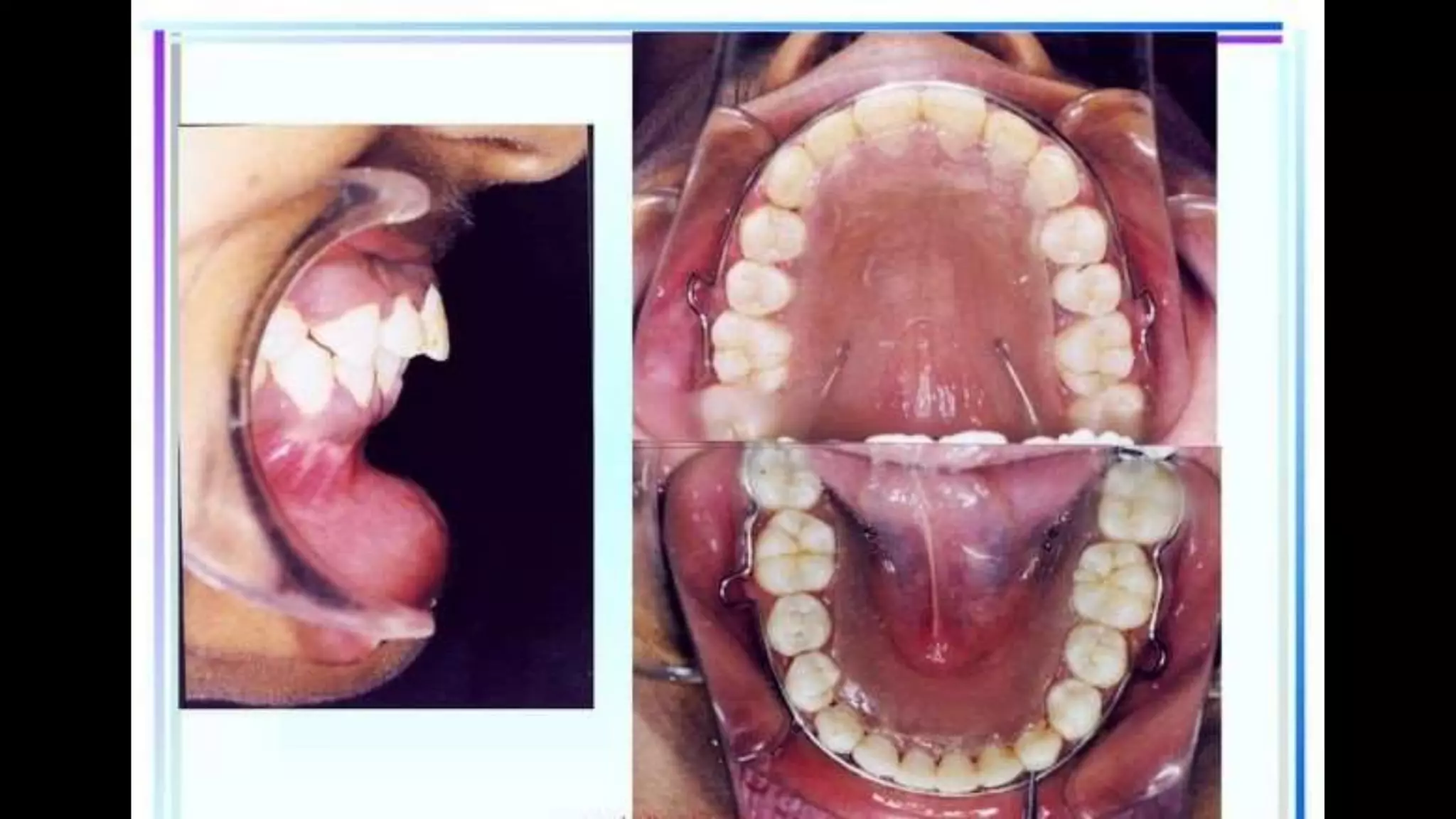 MAXILLARY ROTATION.pptx | Free Download