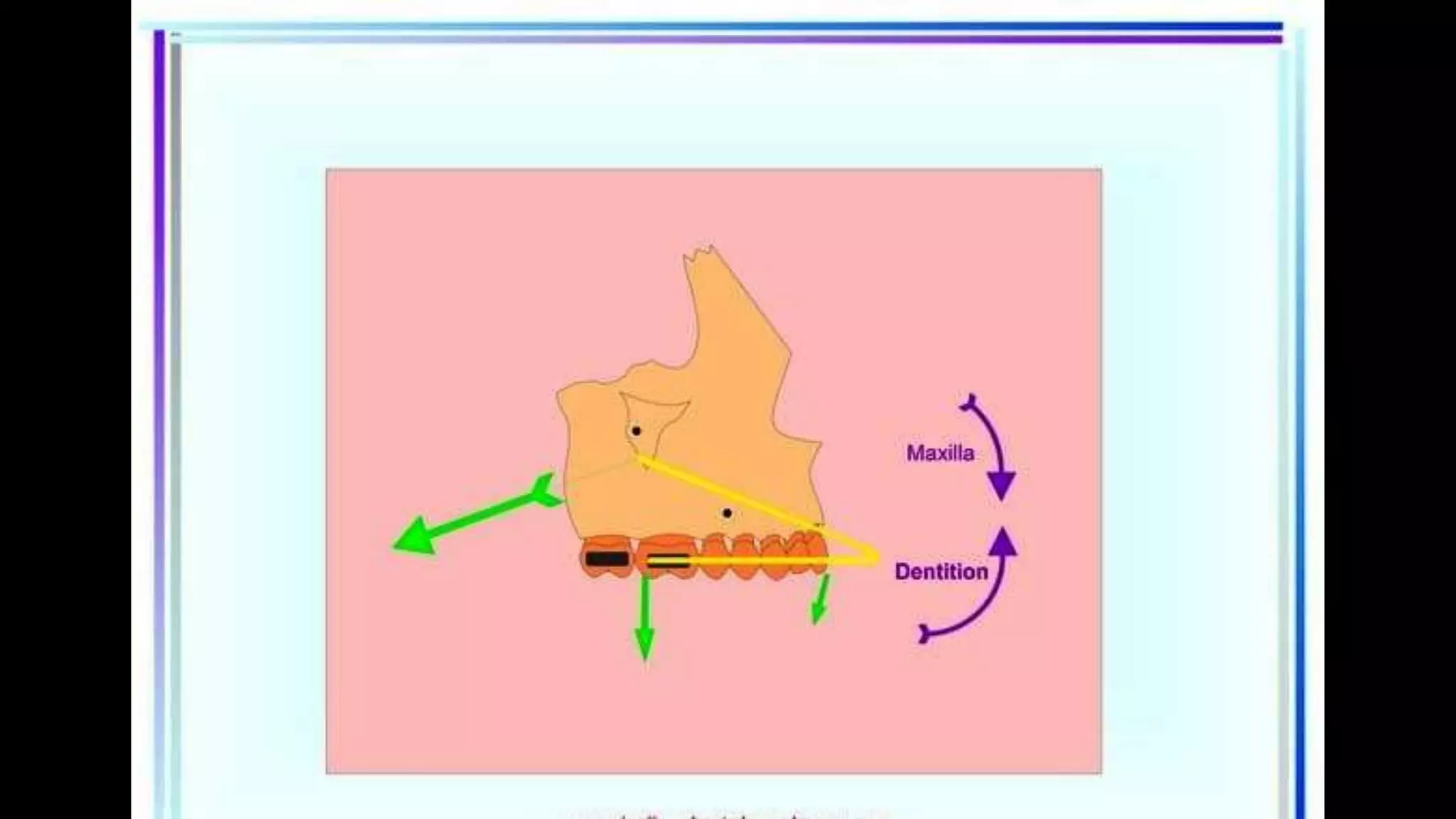 MAXILLARY ROTATION.pptx