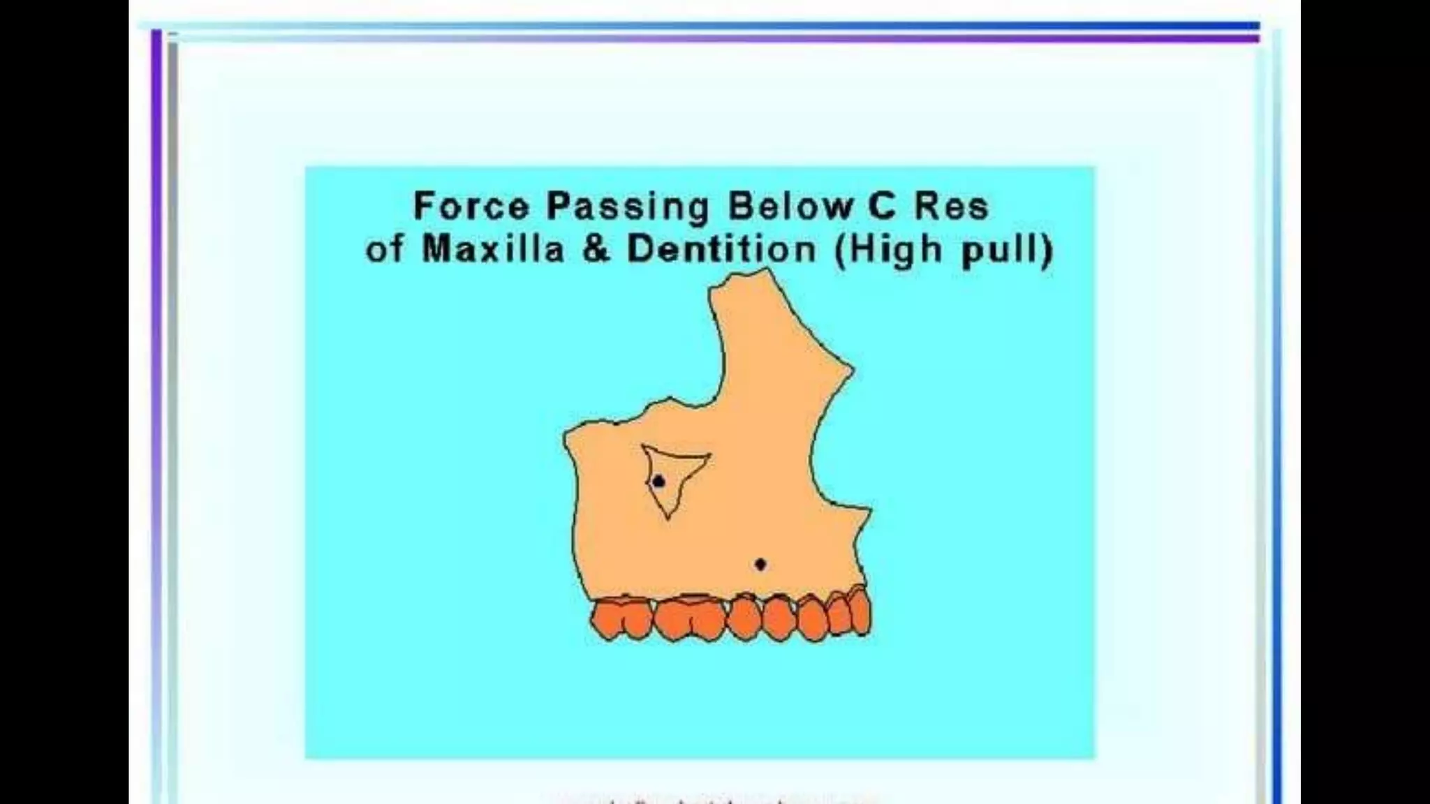 MAXILLARY ROTATION.pptx
