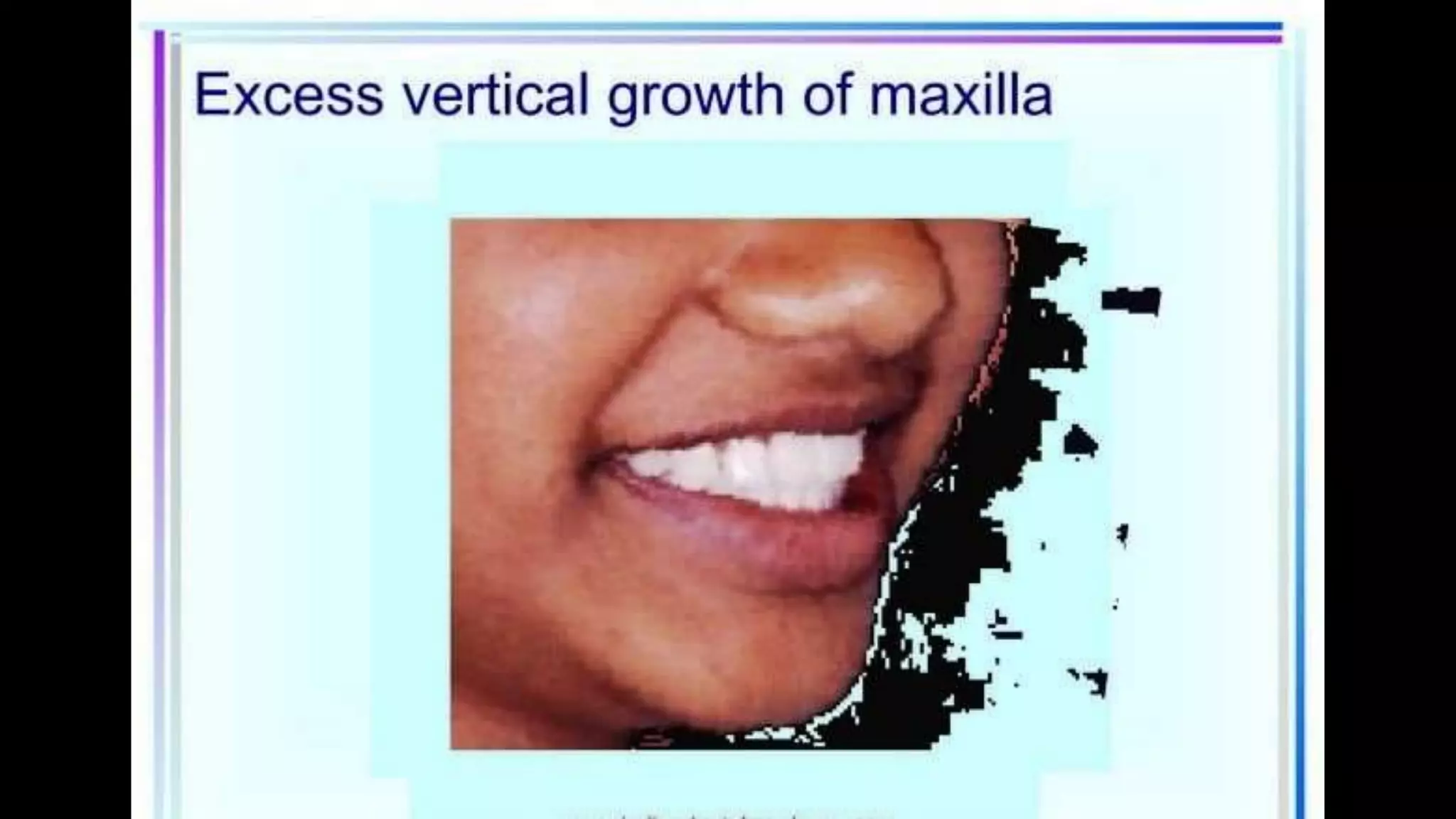 MAXILLARY ROTATION.pptx