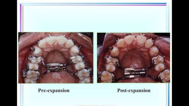 MAXILLARY ROTATION.pptx