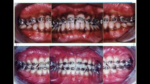 MAXILLARY ROTATION.pptx | Free Download