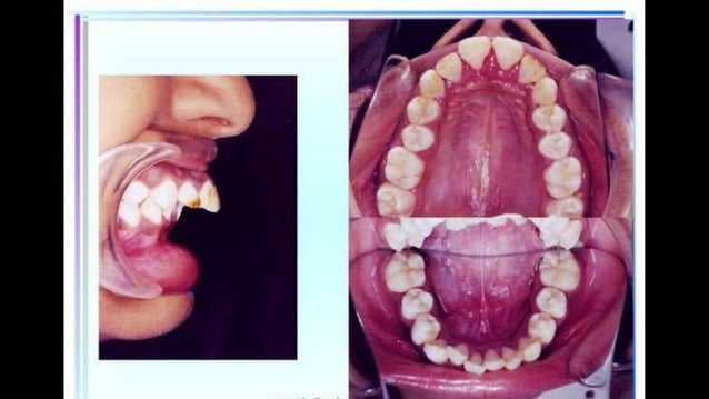 MAXILLARY ROTATION.pptx