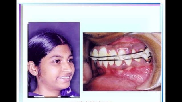 MAXILLARY ROTATION.pptx