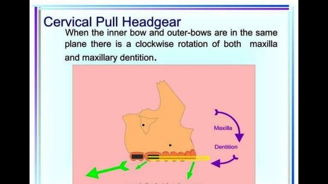 MAXILLARY ROTATION.pptx