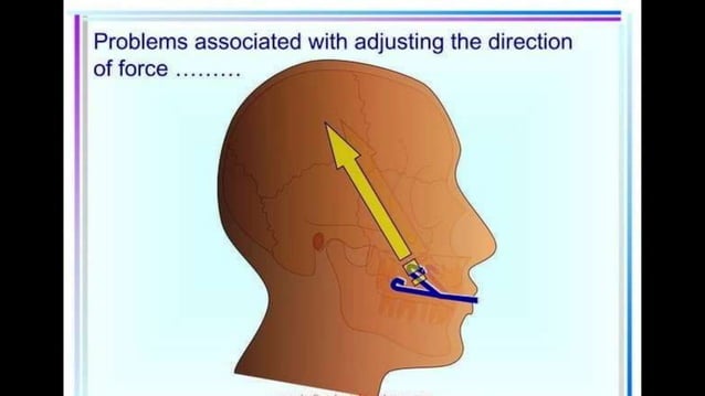 MAXILLARY ROTATION.pptx | Free Download
