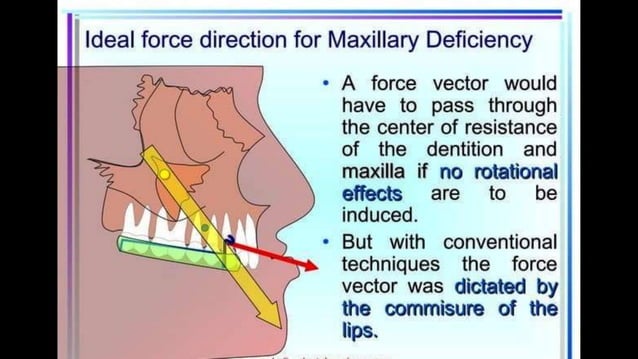 MAXILLARY ROTATION.pptx