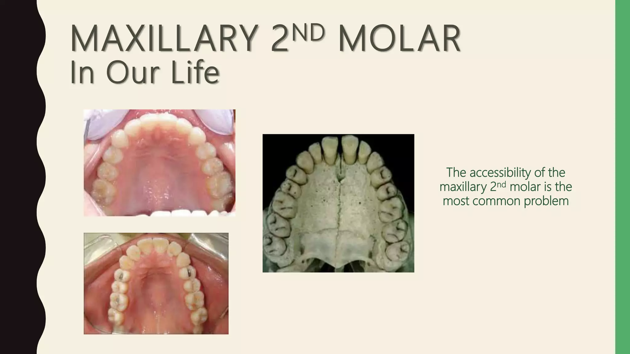 Maxillary second molar | PPTX