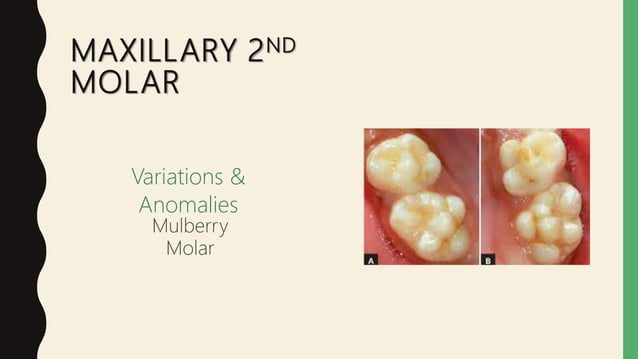 Maxillary second molar | PPTX | Dental Health | Diseases and Conditions