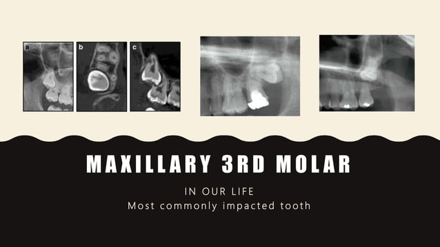 Maxillary second molar | PPTX | Dental Health | Diseases and Conditions