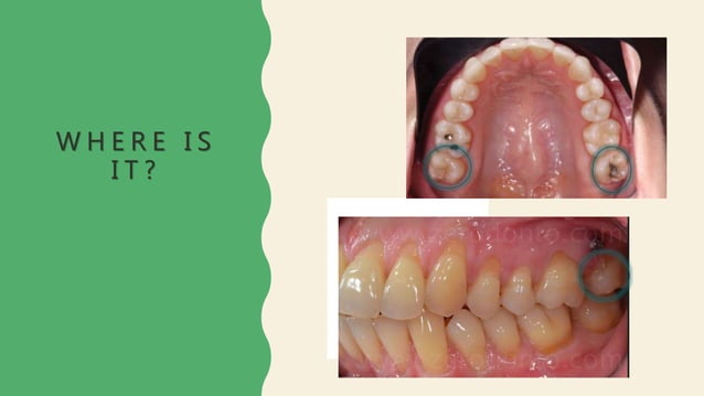 Maxillary second molar | PPTX | Dental Health | Diseases and Conditions