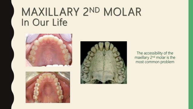Maxillary second molar | PPTX | Dental Health | Diseases and Conditions