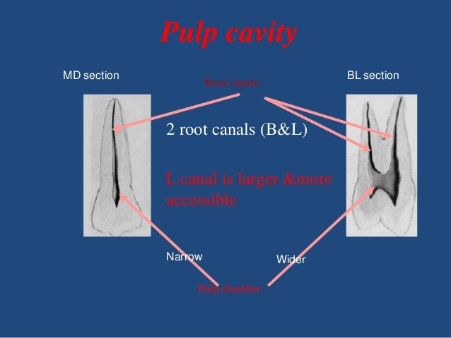 Maxillary First Premolar Canals
