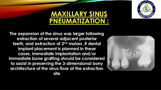 Maxillary sinus